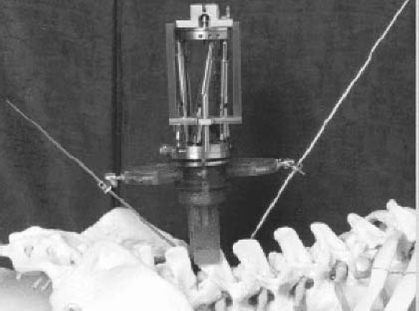 Taylor Spatial Frame (TSF)